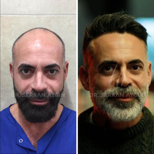 Die Haartransplantation In Der Türkei Auf Erfolgskurs