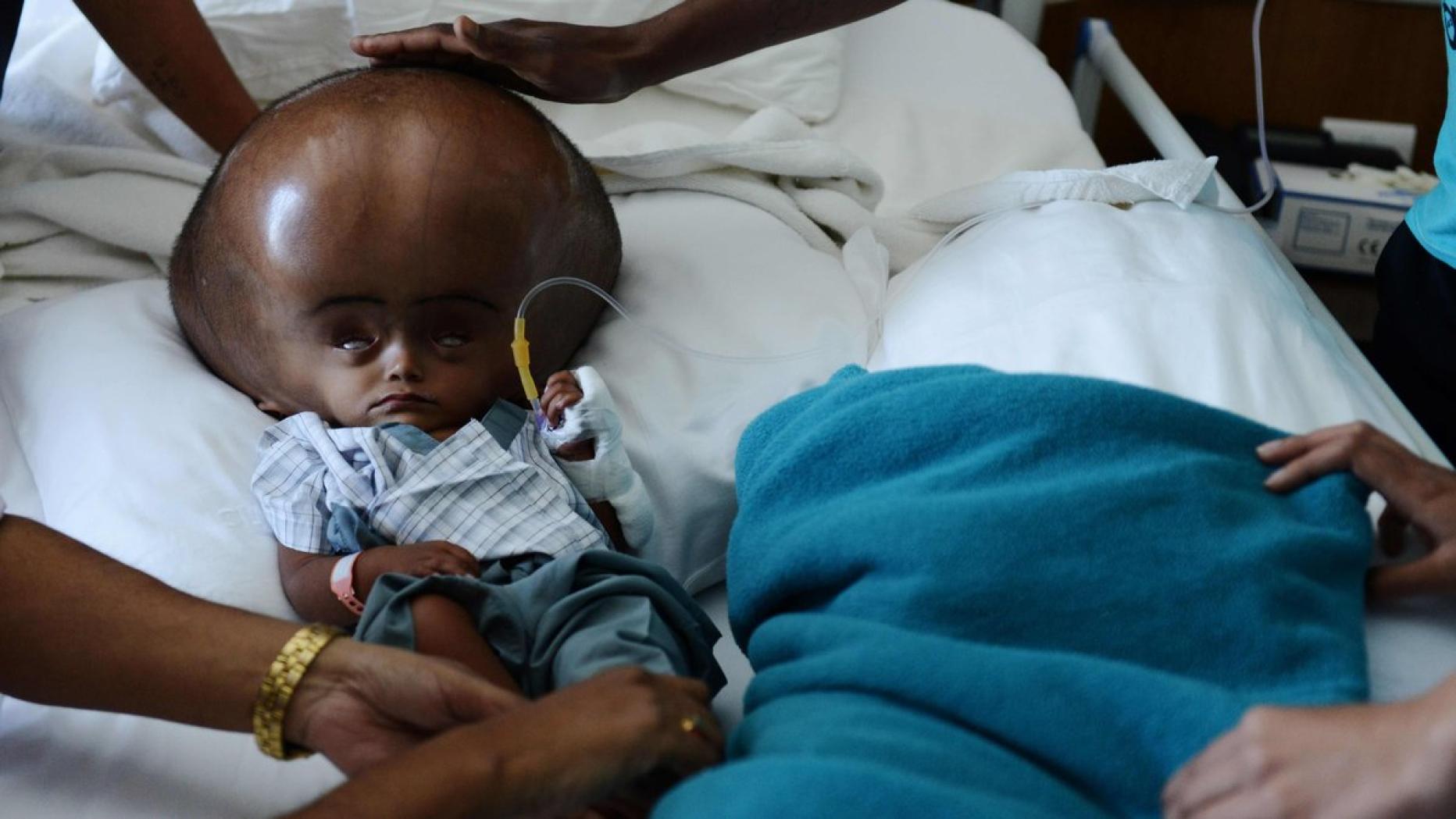 Indien: Mädchen mit Wasserkopf gestorben | Kurier