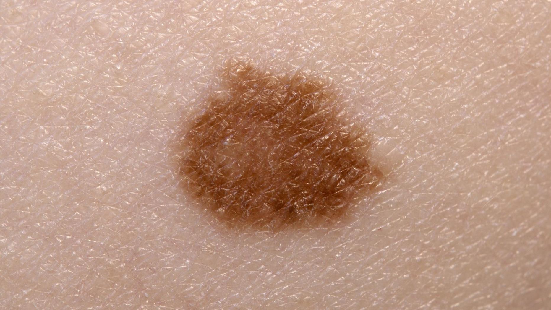 Hautkrebs-Früherkennung: Mediziner entwickelten Handy-App | Kurier