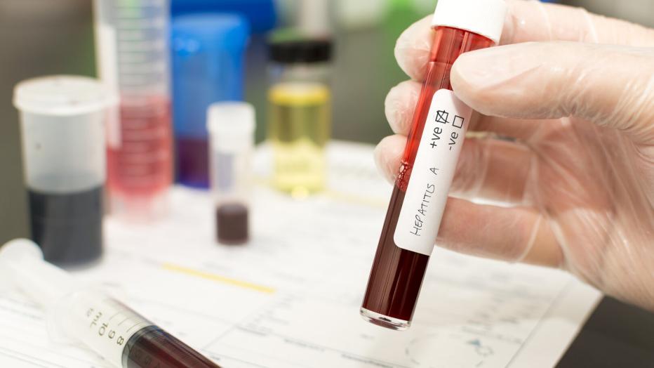 Österreichische Blutspender oft mit Hepatitis E-Antikörpern | Kurier
