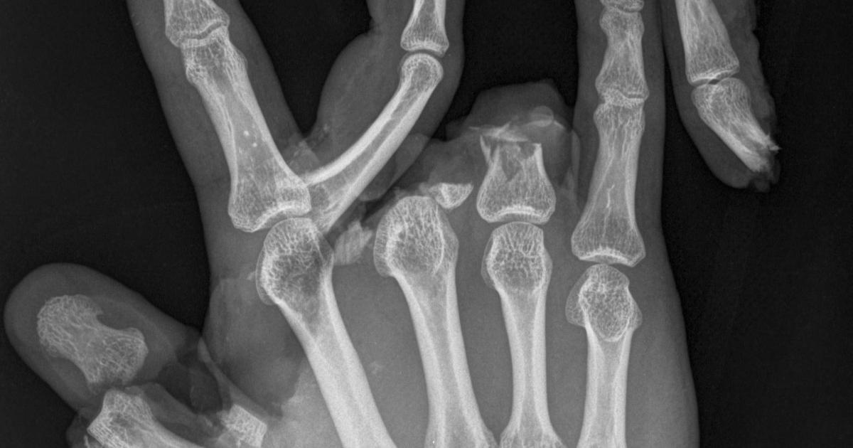 Nach Unfall: Daumen aus zwei Zehen wiederhergestellt | Kurier